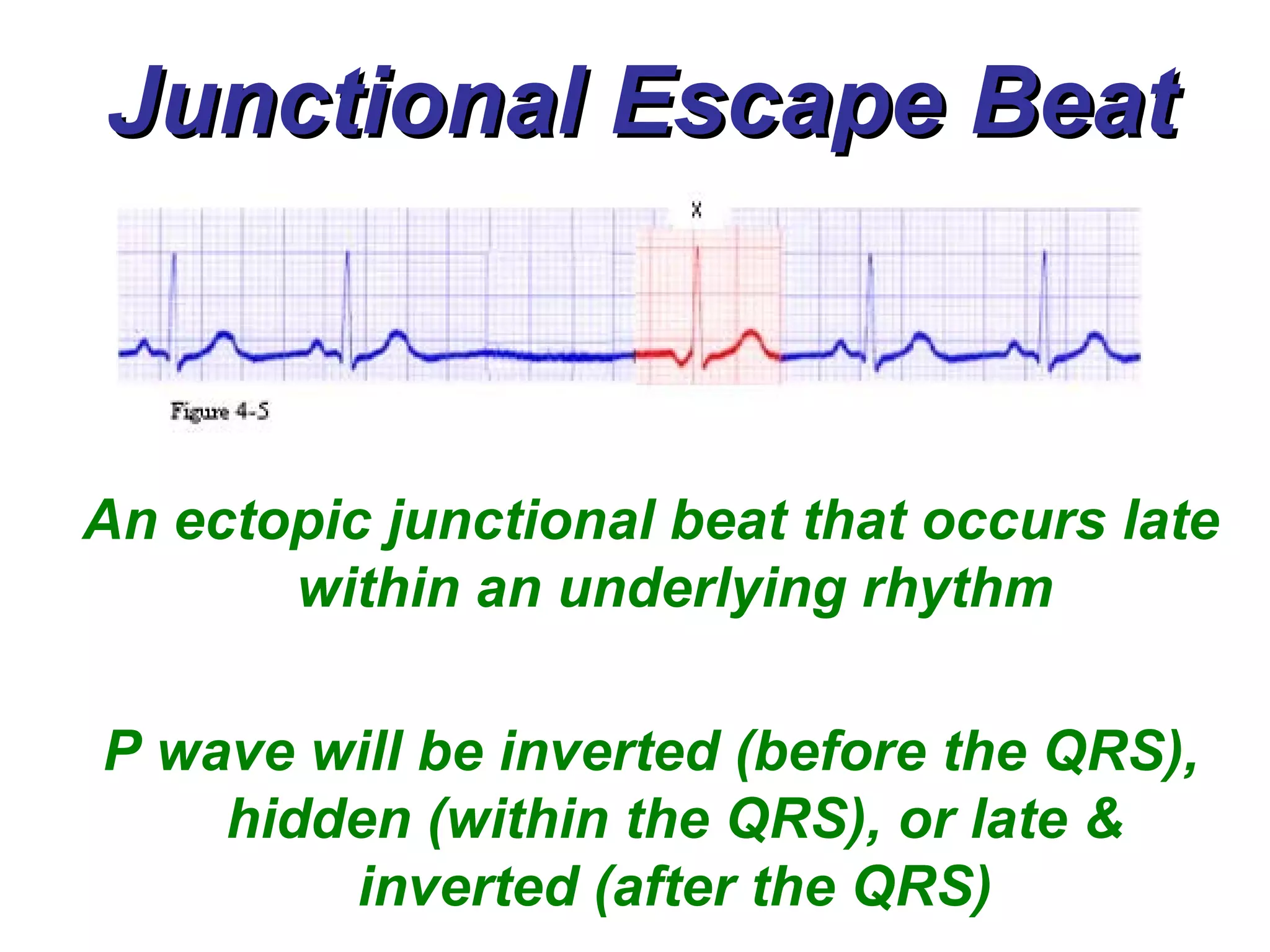 Junctional Rhythms - BMH/Tele | PPT