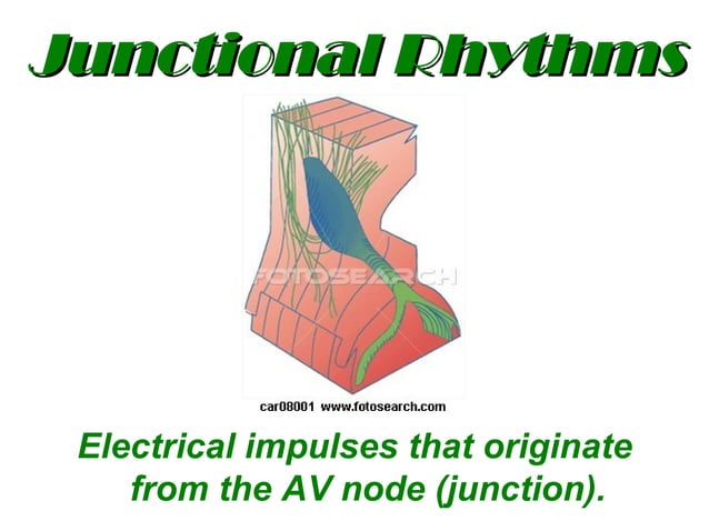 Junctional Rhythms - BMH/Tele | PPT | Heart and Cardiovascular Diseases ...