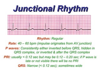 Junctional Rhythms - BMH/Tele | PPT