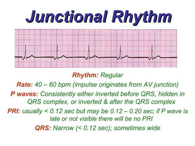 Junctional Rhythms - BMH/Tele | PPT | Heart and Cardiovascular Diseases ...