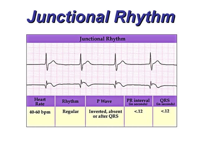 Junctional Rhythms - BMH/Tele | PPT | Heart and Cardiovascular Diseases ...