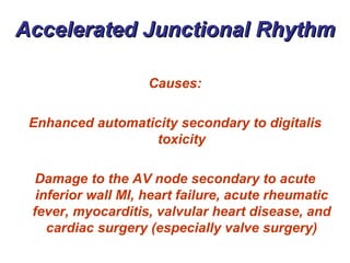 Junctional Rhythms - BMH/Tele | PPT
