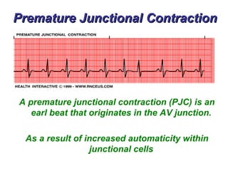Junctional Rhythms - BMH/Tele | PPT