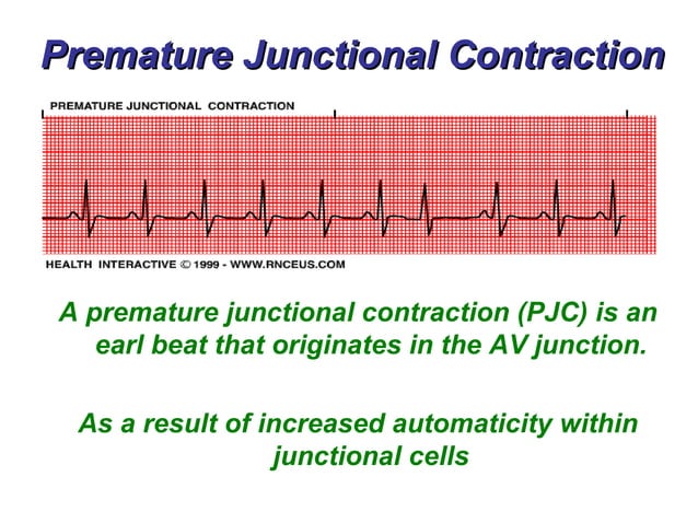 Junctional Rhythms - BMH/Tele | PPT | Heart and Cardiovascular Diseases ...