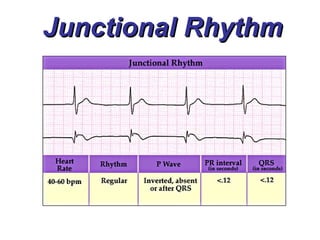 Idioventricular Rhythm Vs Junctional
