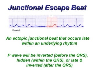 Junctional Ectopic Tachycardia
