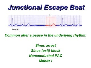 Junctional Rhythm Inverted P Wave