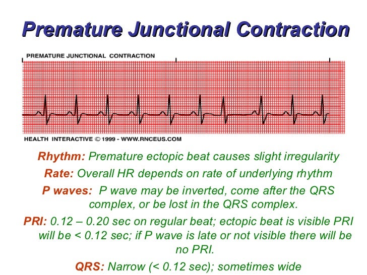 Junctional escape rhythm vs ectopic atrial rhythm - issepics