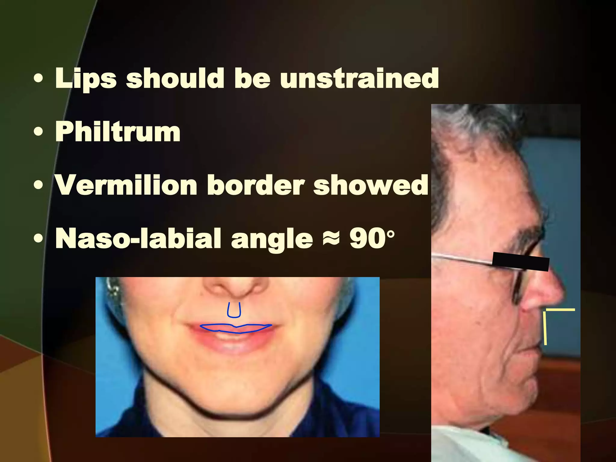 4- b Steps of recording jaw relation for completely edentulous patients ...