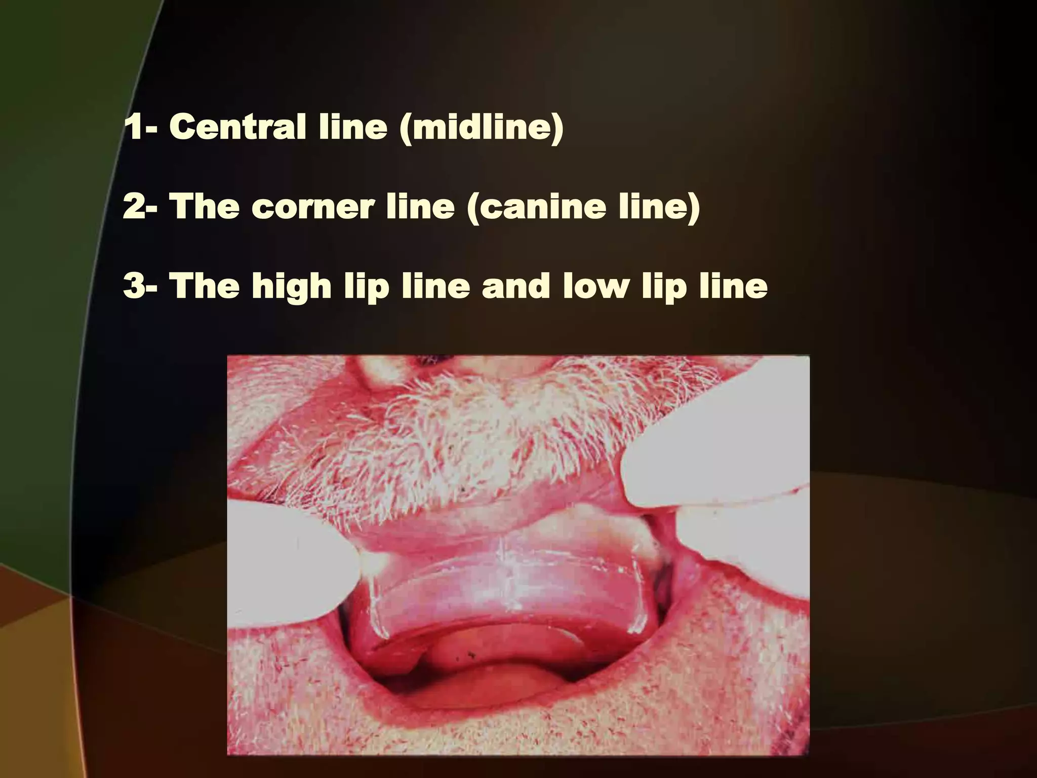 4- b Steps of recording jaw relation for completely edentulous patients ...