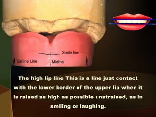 4- b Steps of recording jaw relation for completely edentulous patients ...