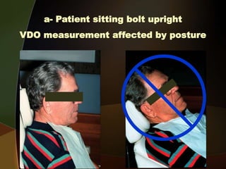 4- b Steps of recording jaw relation for completely edentulous patients ...
