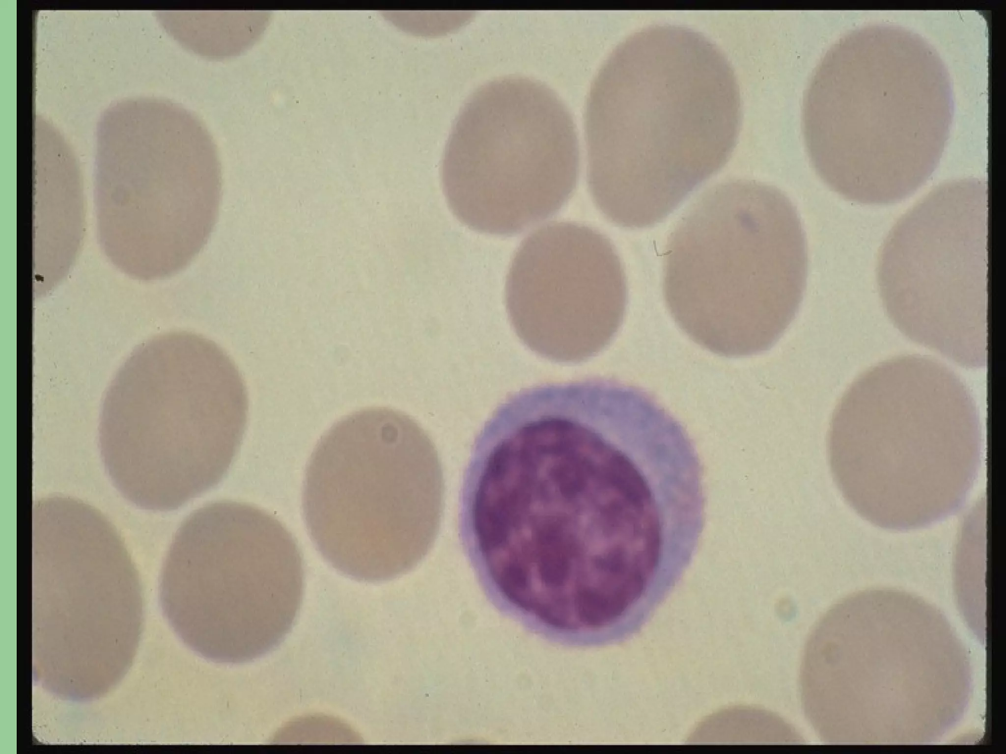 hemolytic anemia (cell membrane defect) | PPT