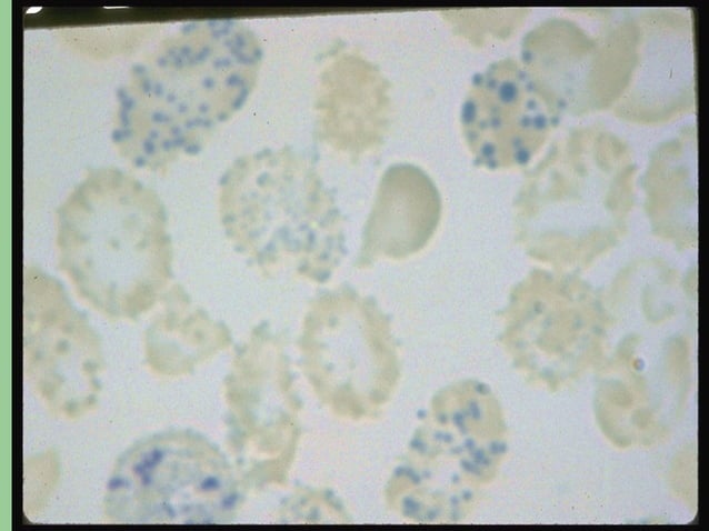 hemolytic anemia (cell membrane defect) | PPT