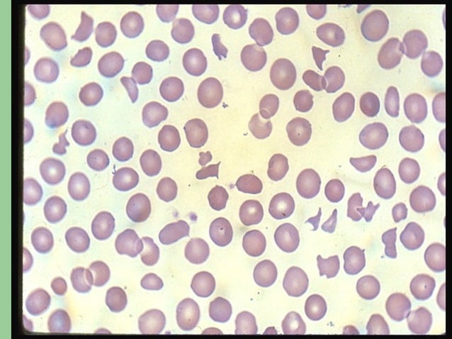 hemolytic anemia (cell membrane defect) | PPT