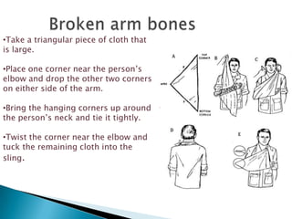 4 bandages and slings | PPTX