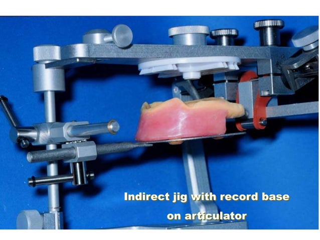 4. c- Face Bow Record | PPT | Dental Health | Diseases and Conditions