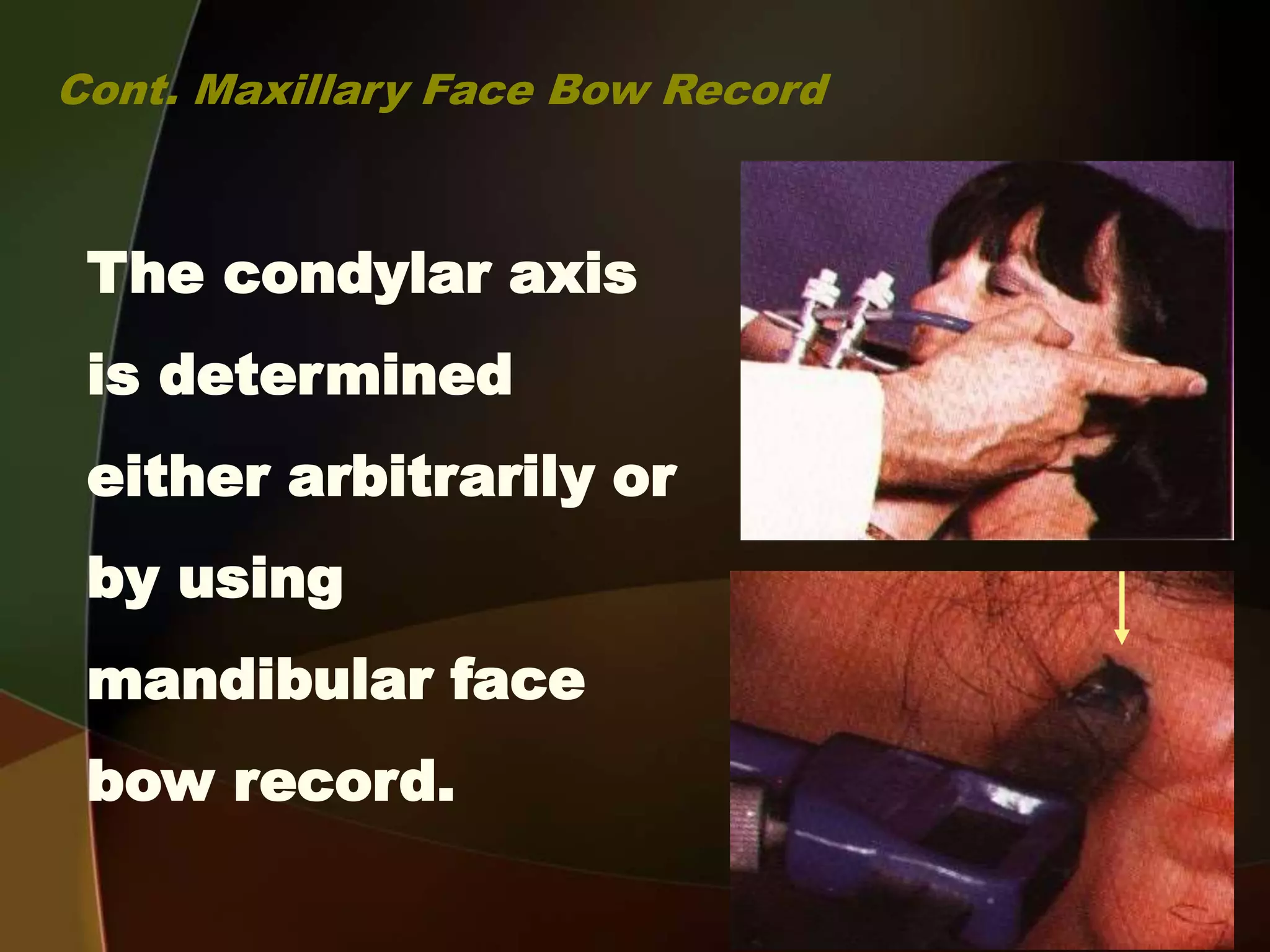 4- c Maxillo-mandibular Relation Records -Face bow record and transfer ...