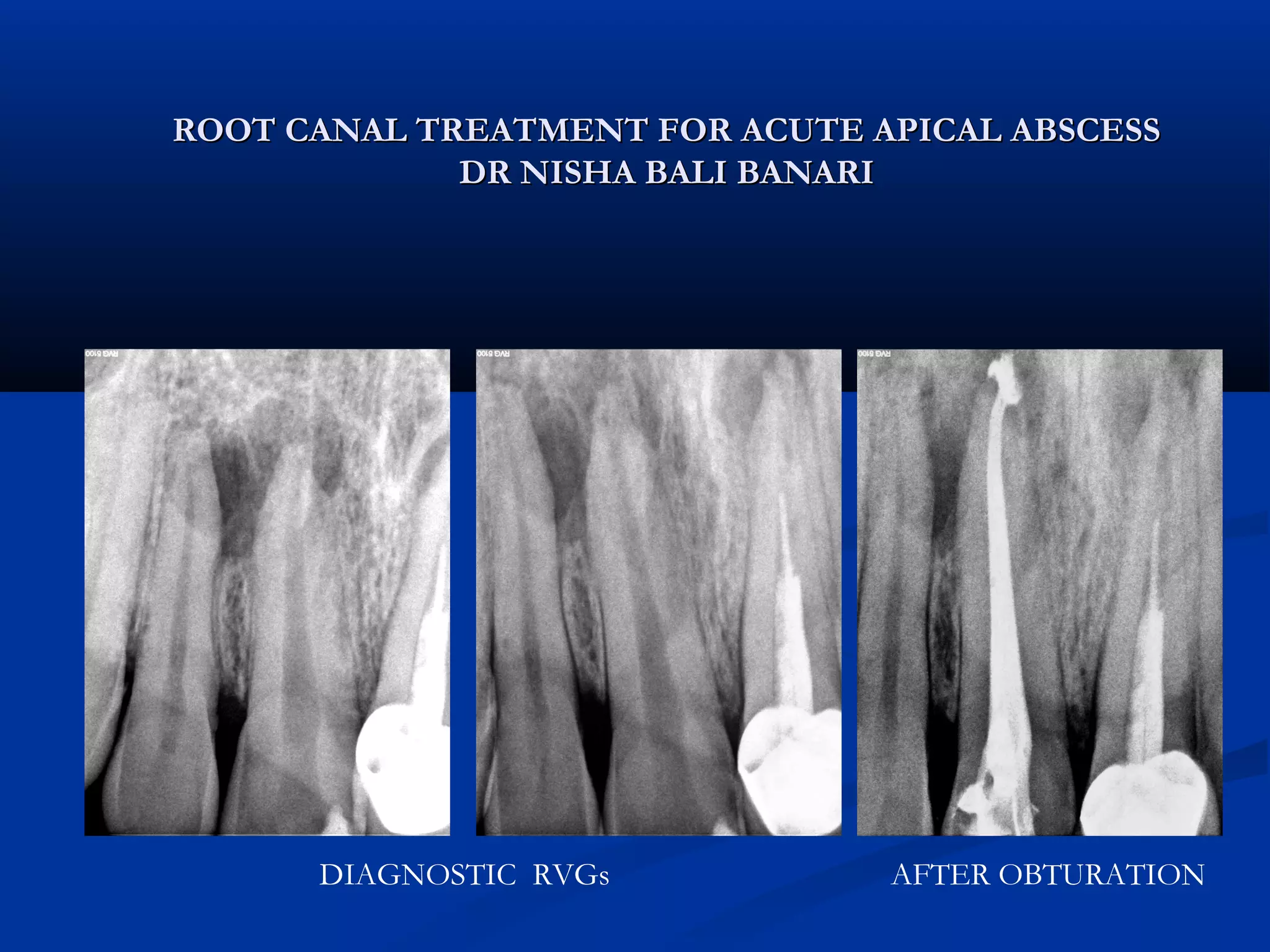 ACUTE APICAL ABSCESS | PPT