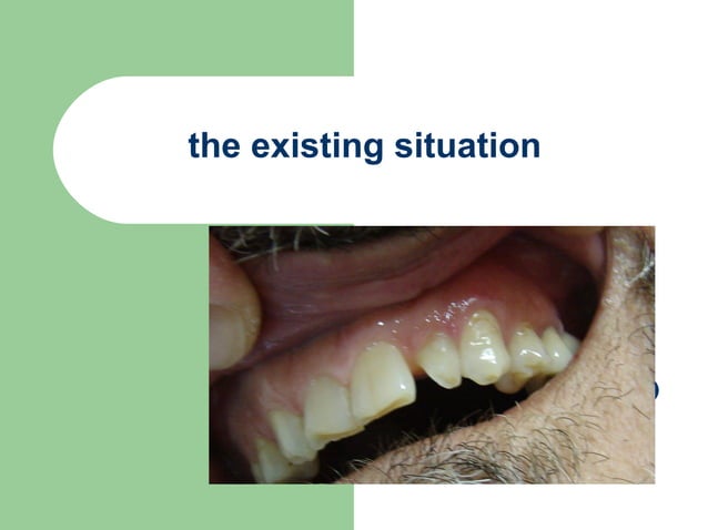 reconstruction of teeth 22 with GRADIA | PPT
