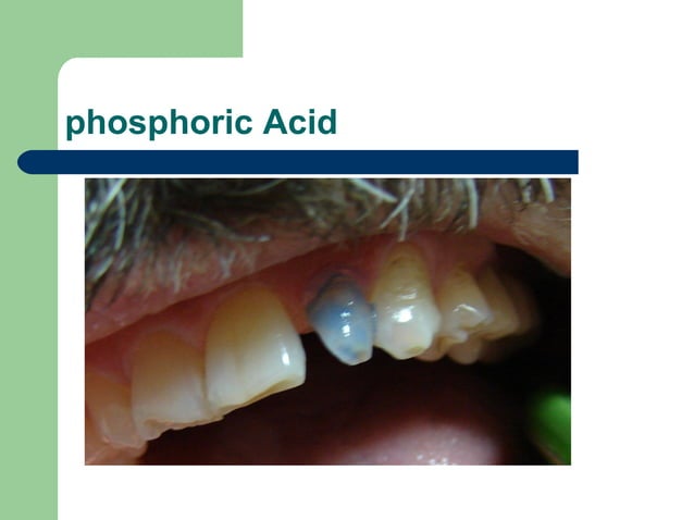reconstruction of teeth 22 with GRADIA | PPT