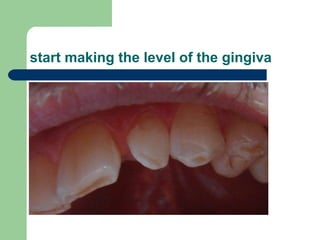 reconstruction of teeth 22 with GRADIA | PPT