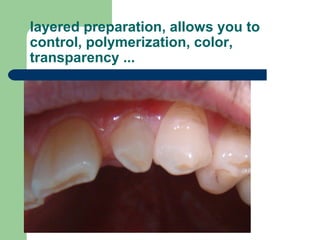 reconstruction of teeth 22 with GRADIA | PPT