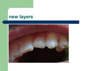 reconstruction of teeth 22 with GRADIA | PPT