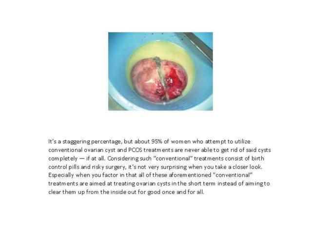 4 Cm Ovarian Cyst | PPTX