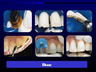 composite resin dental material | PPS