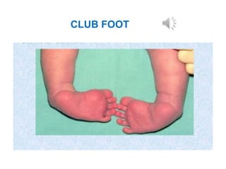 CONGENITAL DISORDERS IN MUSCULOSKELETAL SYSTEM | PPTX