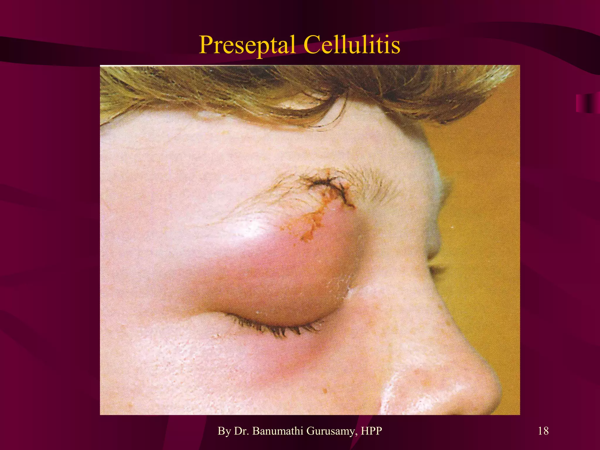 Eye Infections | PPT