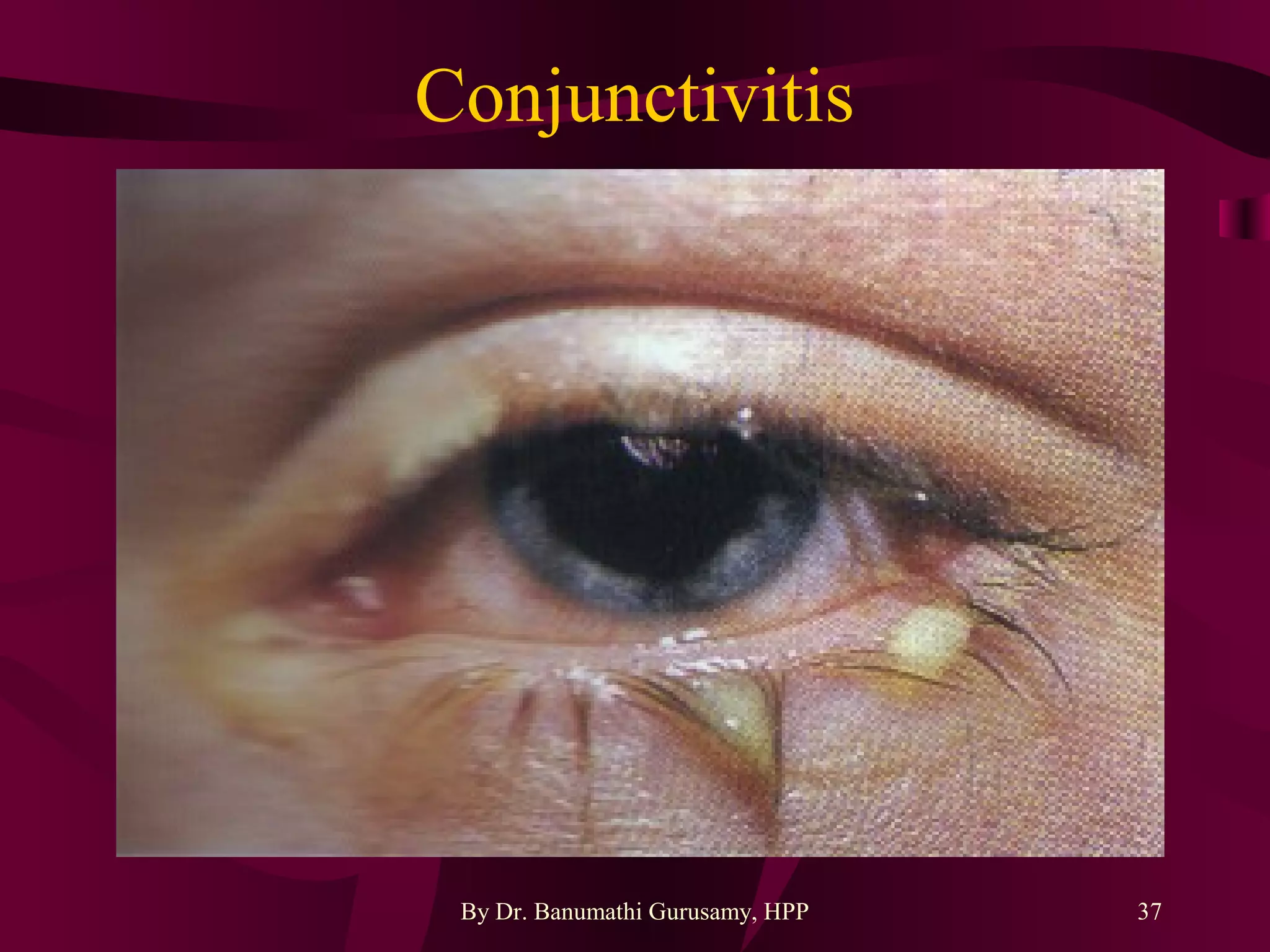 Eye Infections | PPT