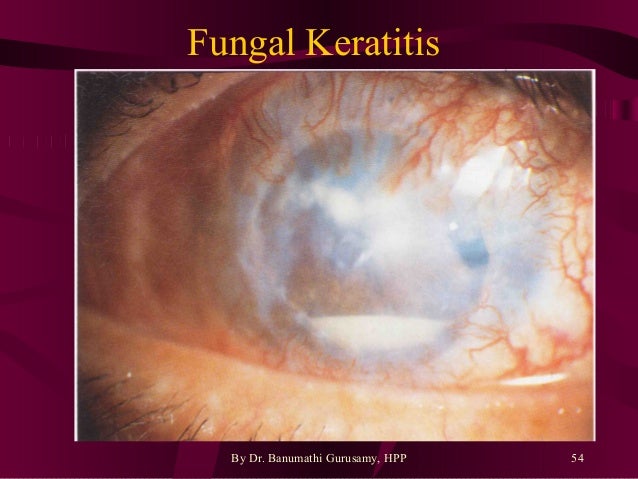 Images Eye Infections Fungal Mycosis Ocular Mycotic Infections Ocular ...