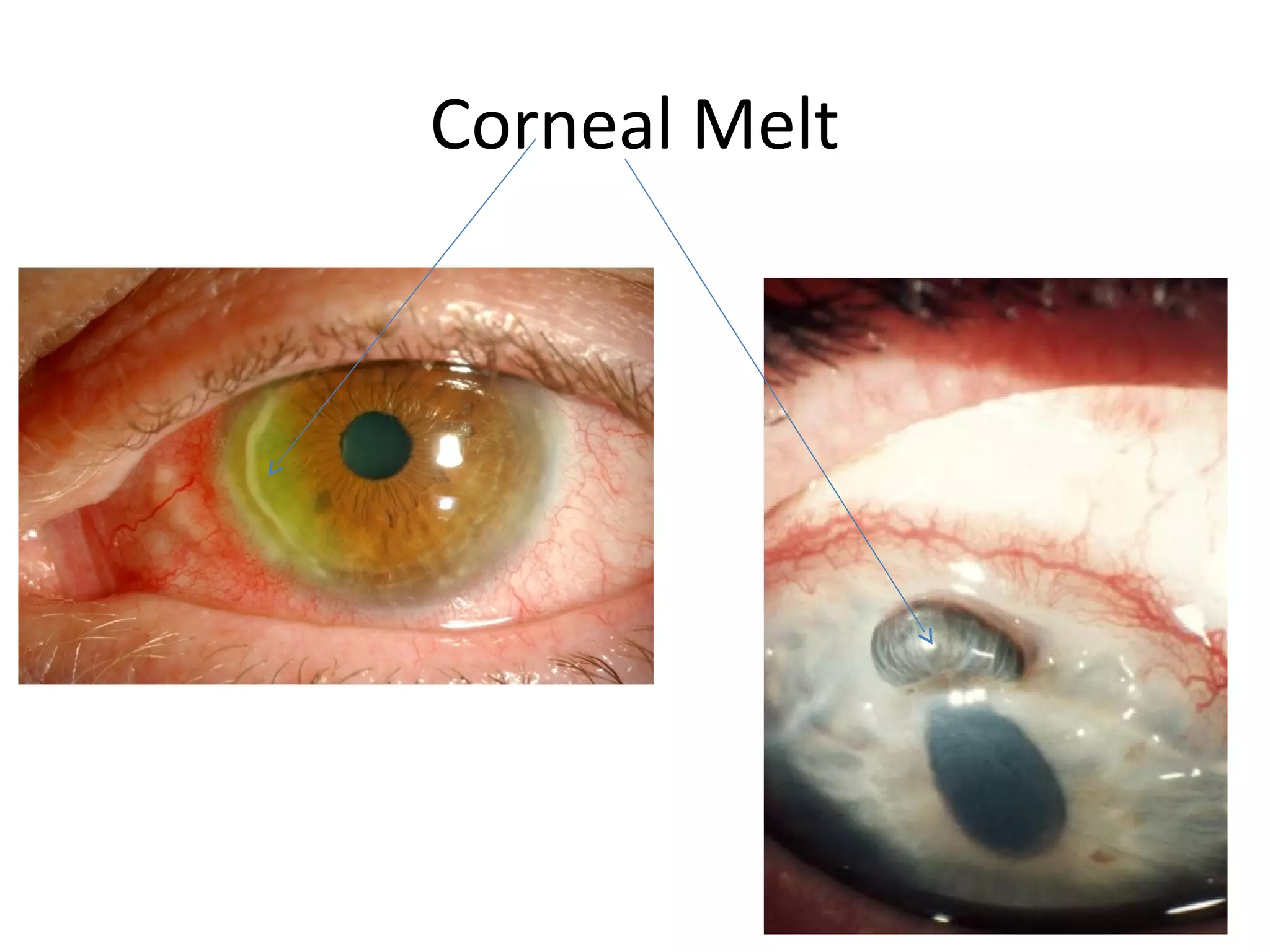 Cornea | PPT