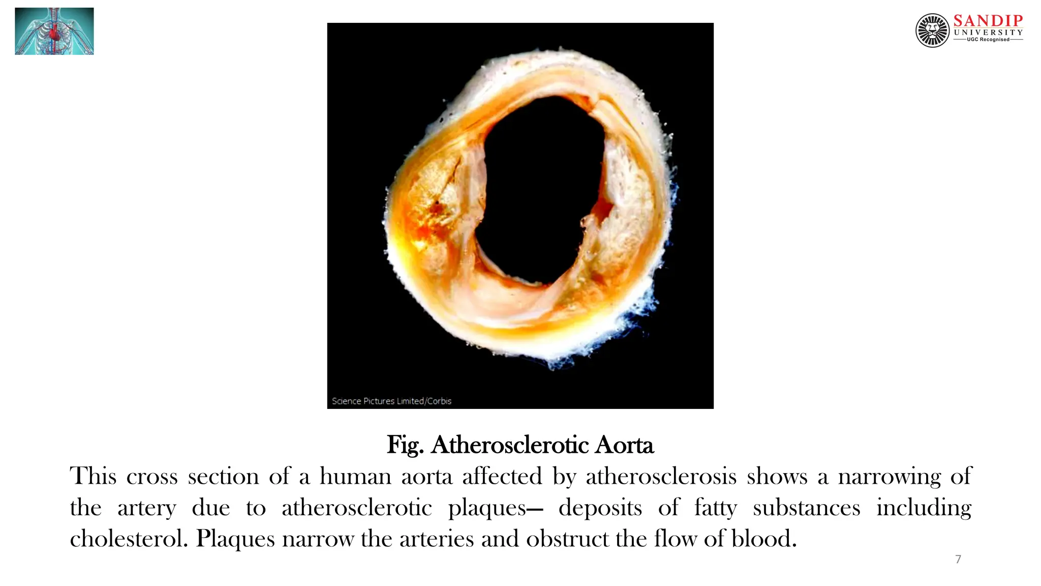 Cardiovascular Pathophysiology- Coronary Atherosclerosis and Arteriosclerosis | PDF
