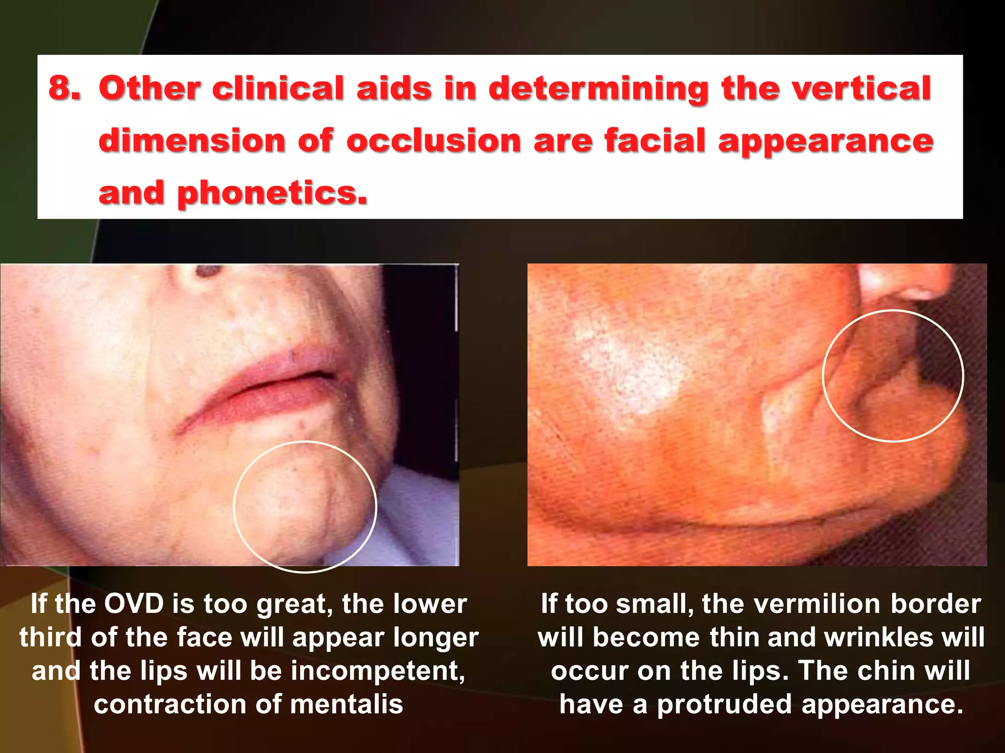 Clinical Steps for Complete Denture Construction -Steps of recording ...