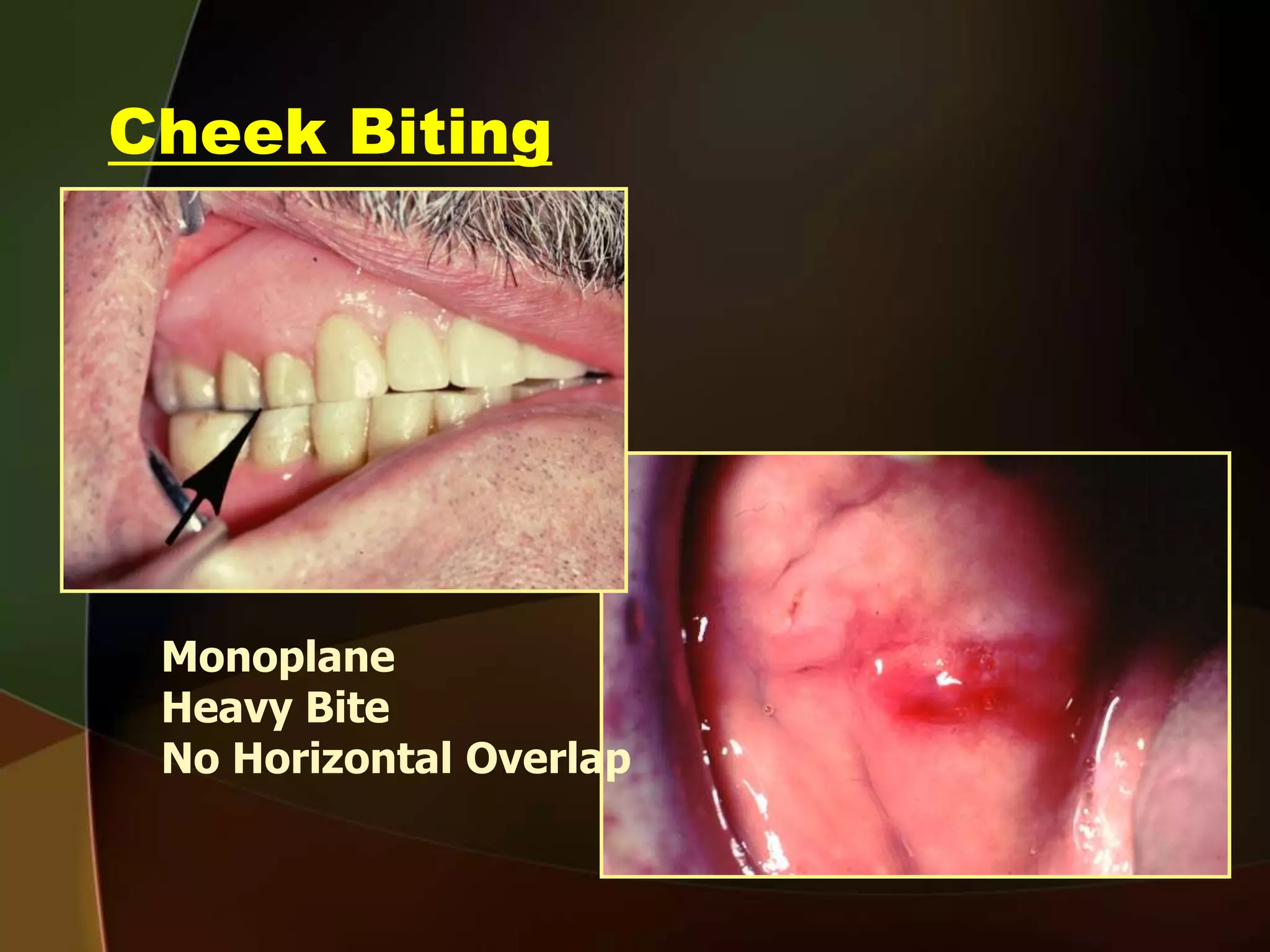 Clinical Steps for Complete Denture Construction -Steps of recording ...