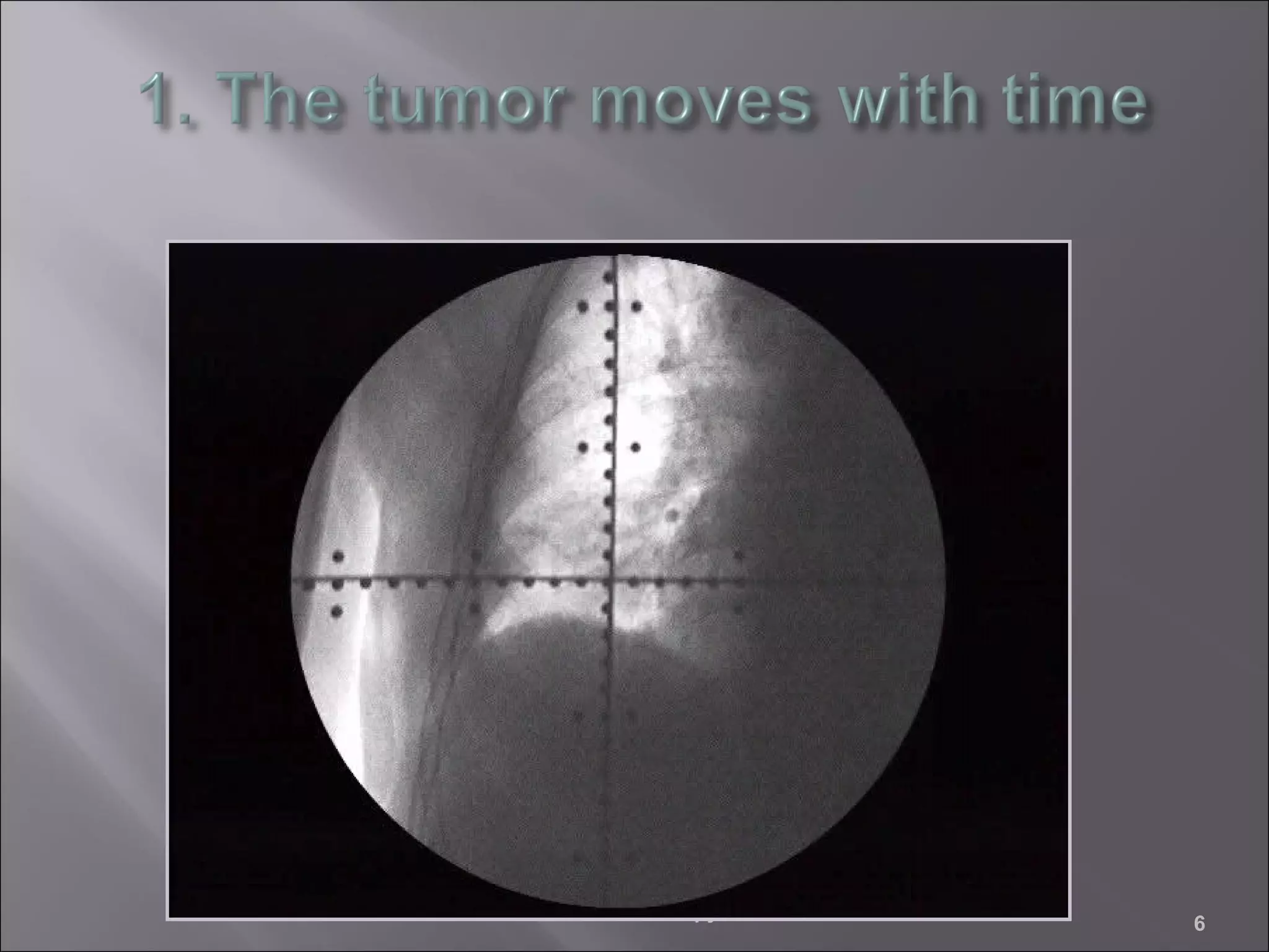 4 dcrt, FourDimensionalConventionalRadiationTreatment | PPT