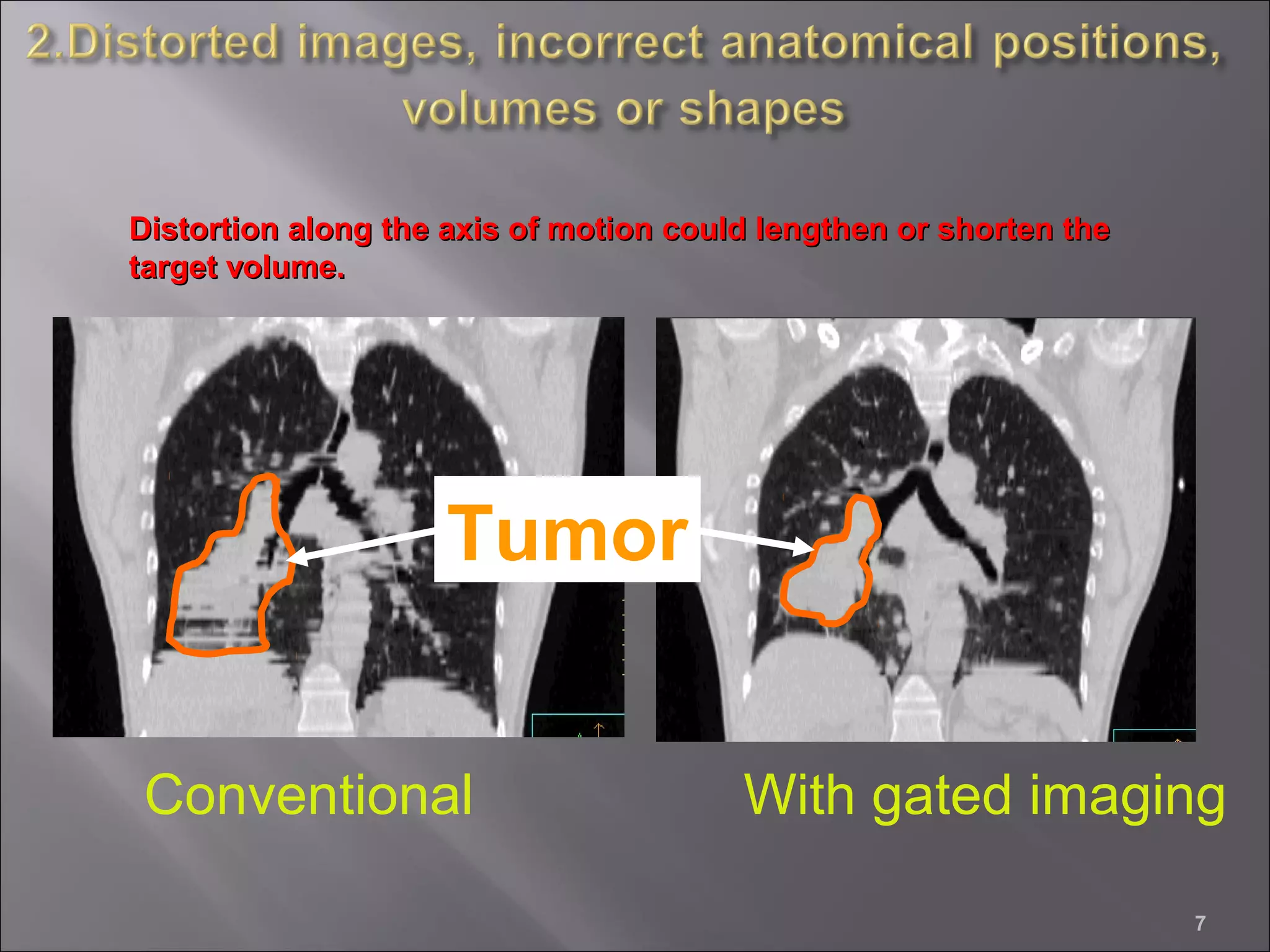 4 dcrt, FourDimensionalConventionalRadiationTreatment | PPT