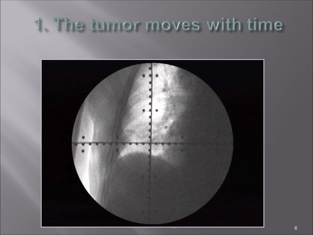 4 dcrt, FourDimensionalConventionalRadiationTreatment | PPT