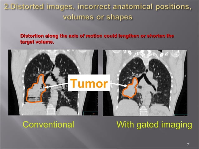 4 dcrt, FourDimensionalConventionalRadiationTreatment | PPT