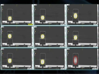 4DCT driving improved lung radiotherapy outcomes at NCCI | PPTX