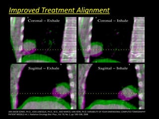 4DCT driving improved lung radiotherapy outcomes at NCCI | PPTX