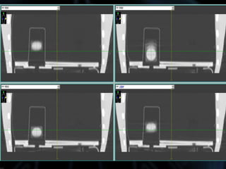 4DCT driving improved lung radiotherapy outcomes at NCCI | PPTX