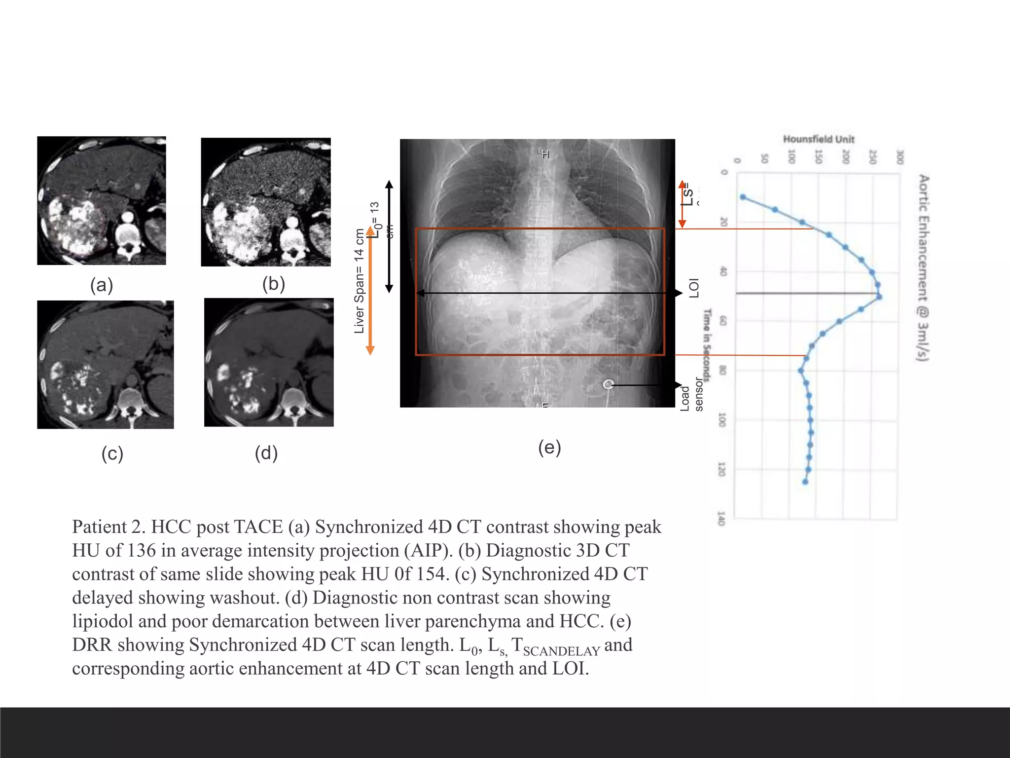 4 D CT simulation with synchronized intravenous contrast injection | PPTX