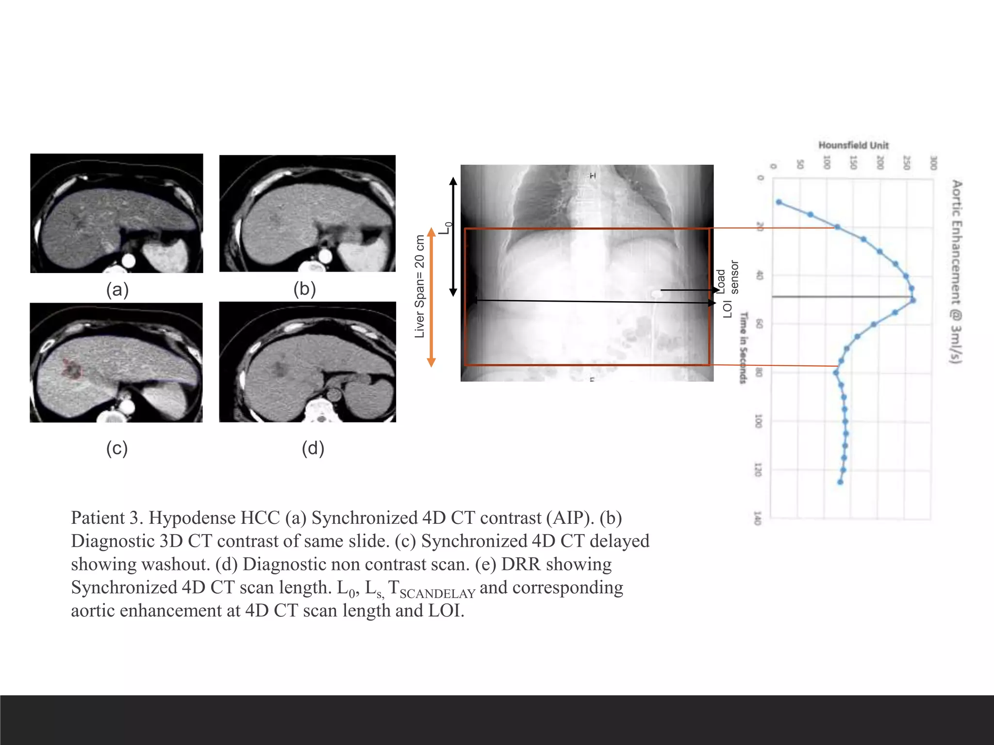 4 D CT simulation with synchronized intravenous contrast injection | PPTX