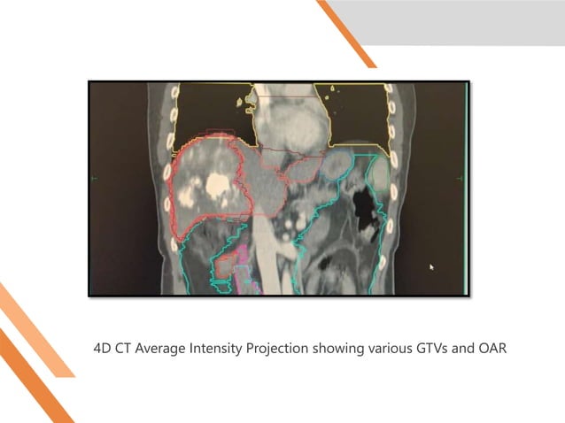4 D CT simulation with synchronized intravenous contrast injection ...