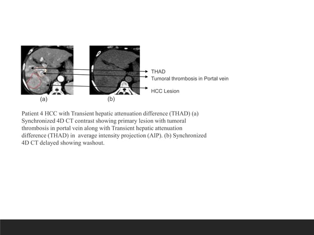 4 D CT simulation with synchronized intravenous contrast injection ...