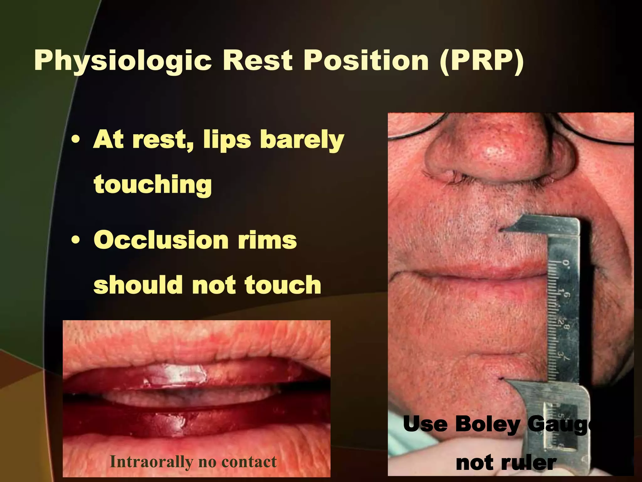 Complete Denture 4- Maxillo-mandibular Relation Records d- Vertical ...